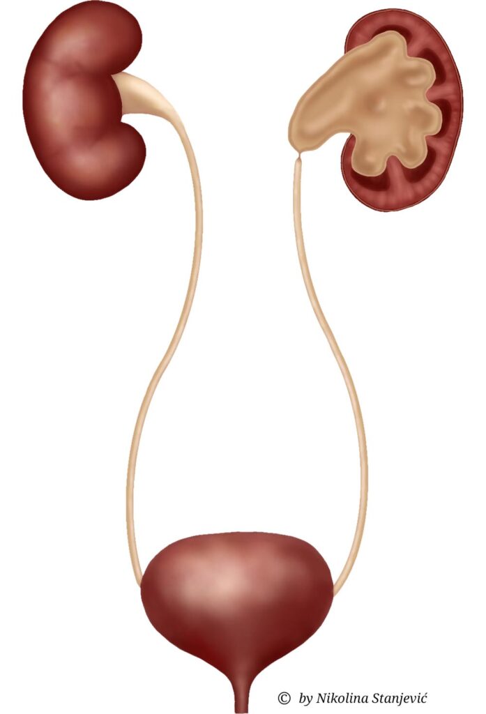 Laparoskopska pijelonplastika